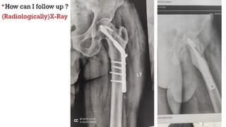 strut graft enhance neck femur union in.pptx