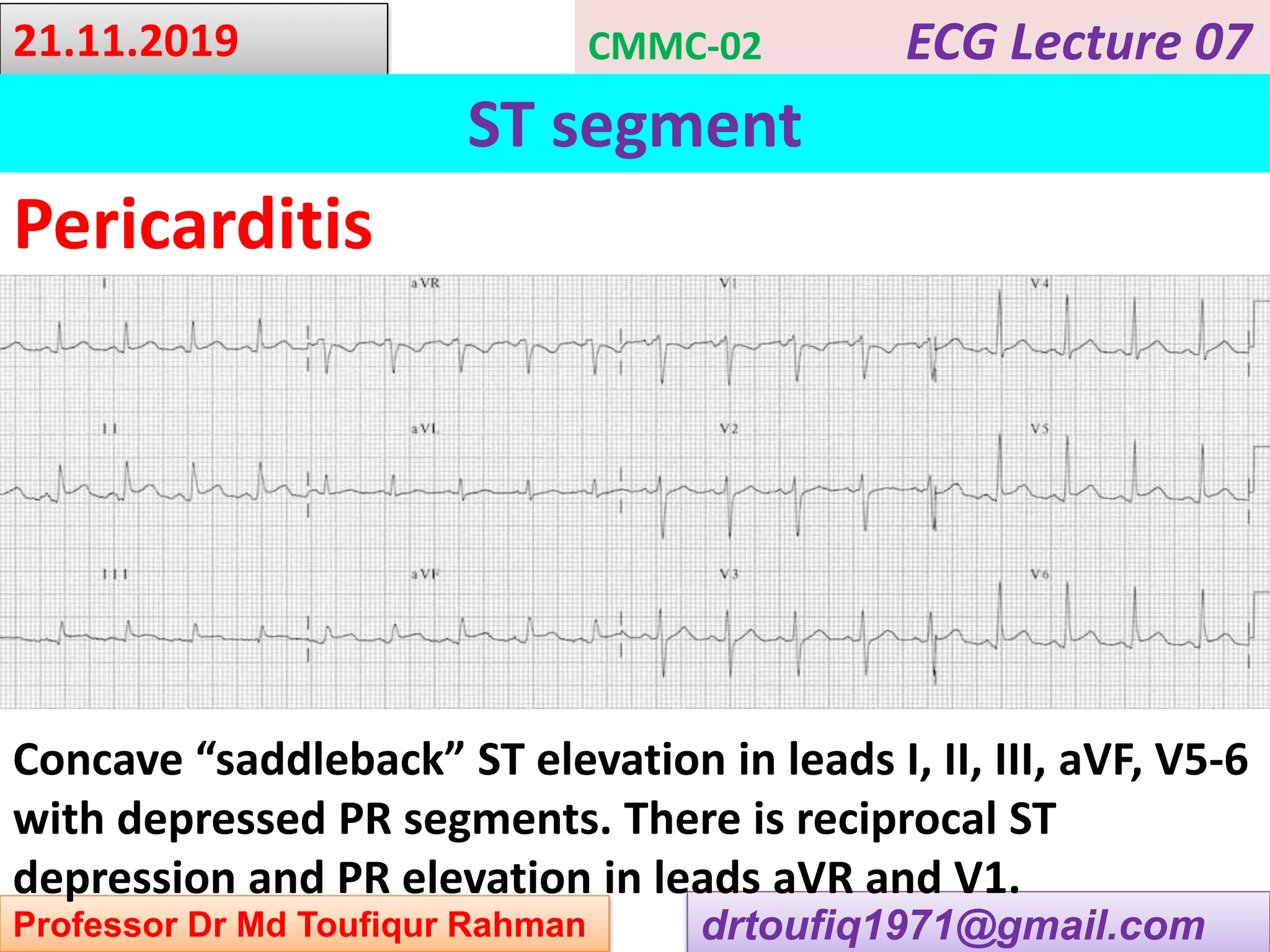ECG- ST segment | PPSX