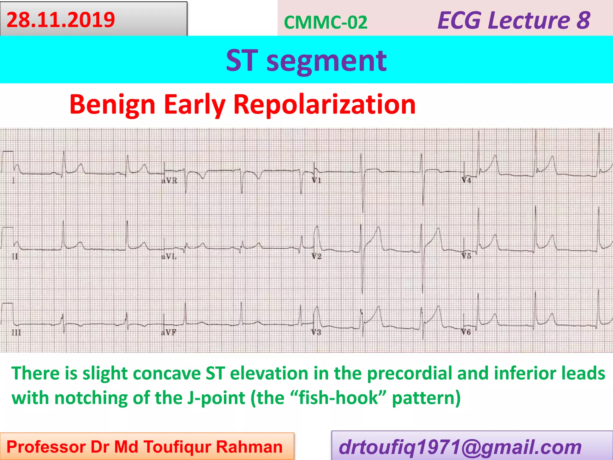 ECG- ST segment | PPSX