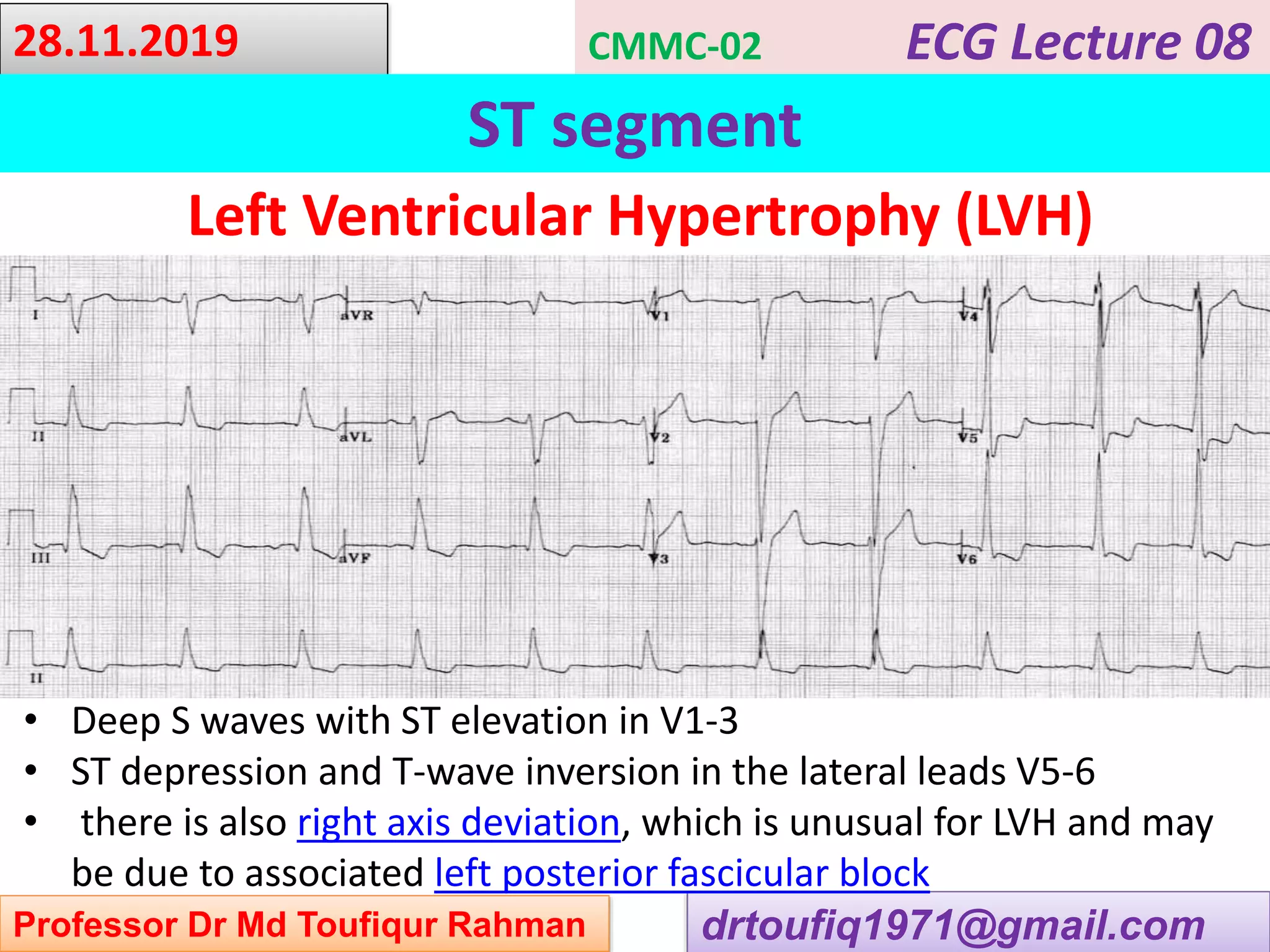 ECG- ST segment | PPSX