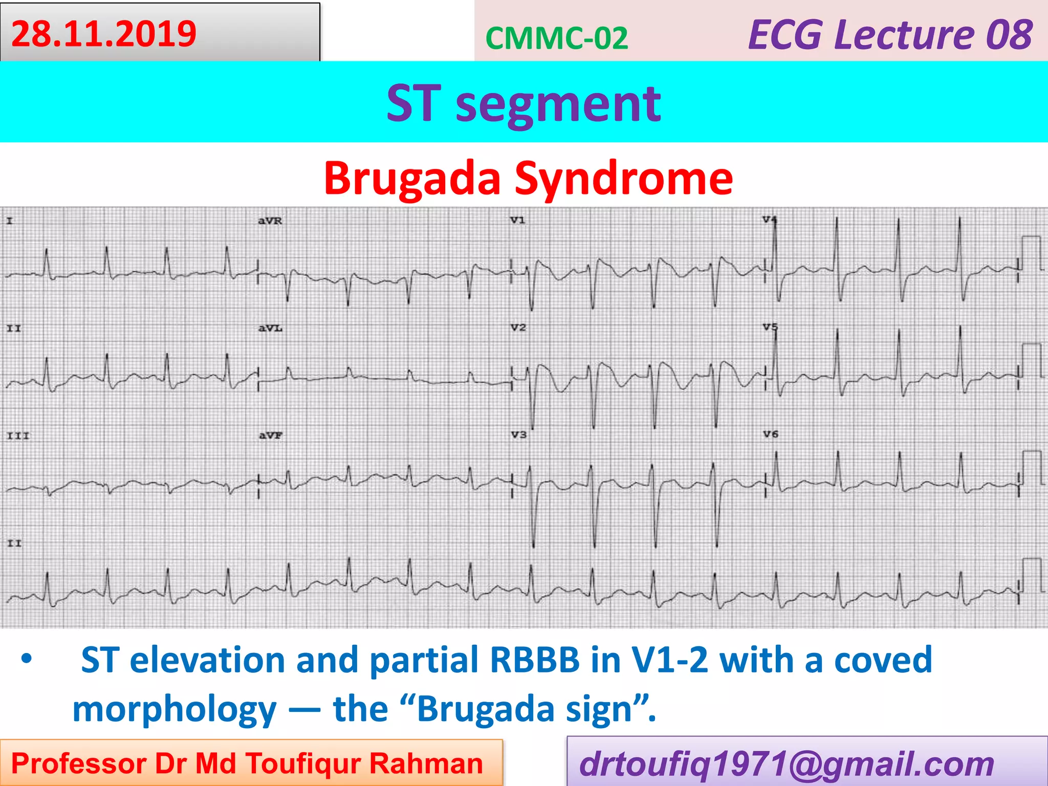 ECG- ST segment | PPSX