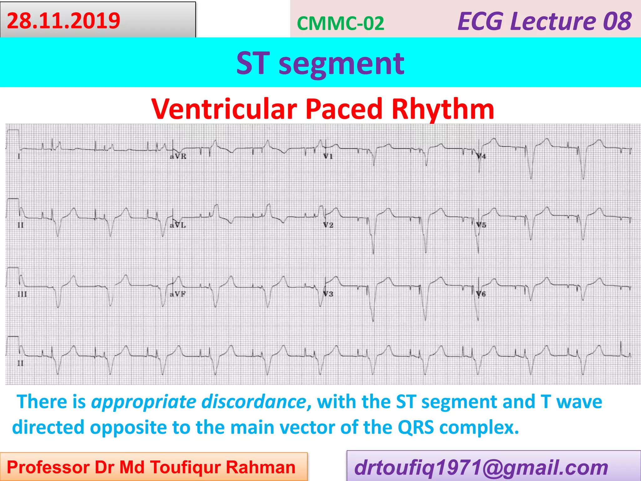 ECG- ST segment | PPSX