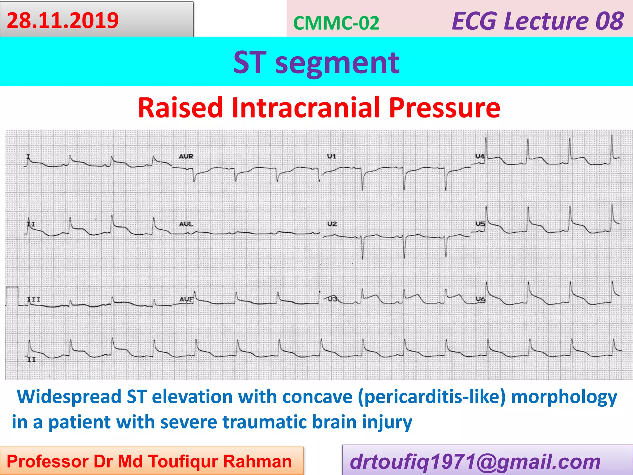 ECG- ST segment | PPSX