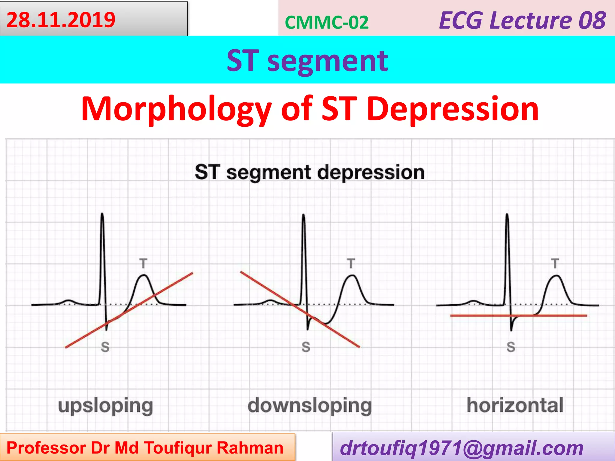 ECG- ST segment | PPSX