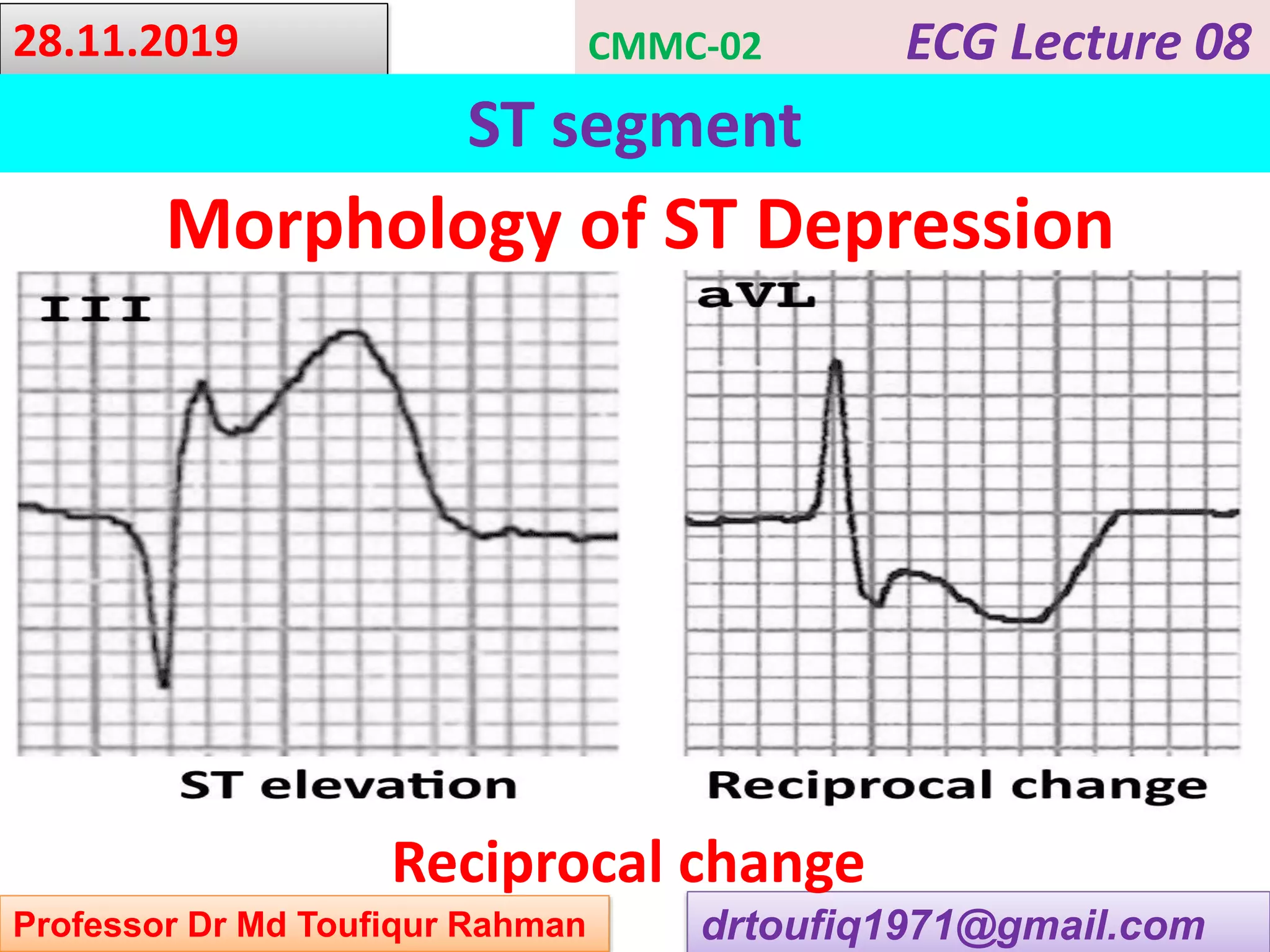ECG- ST segment | PPSX