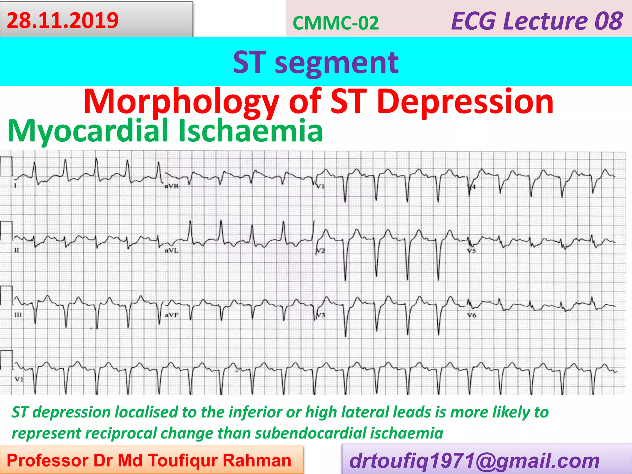 ECG- ST segment | PPSX