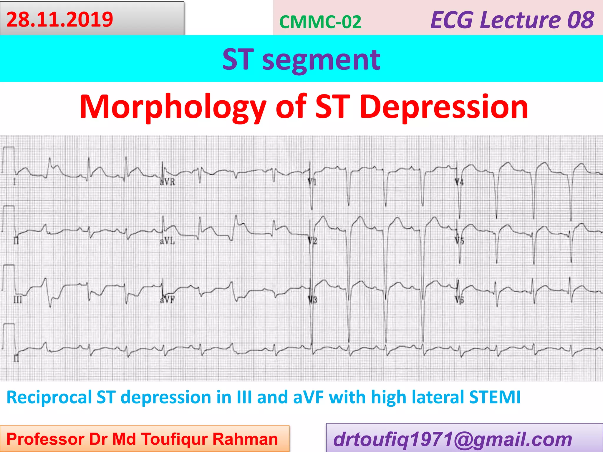 ECG- ST segment | PPSX