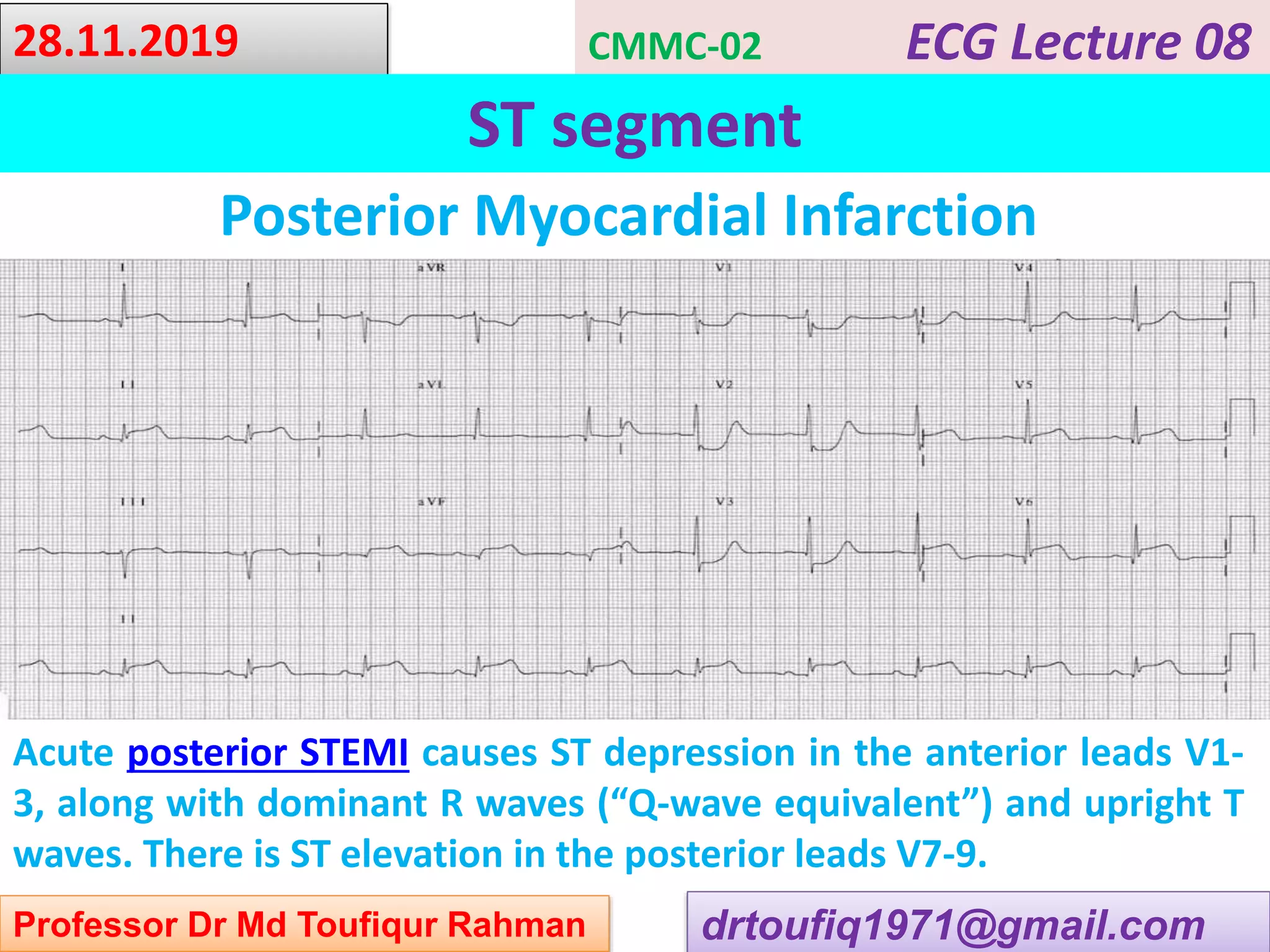 ECG- ST segment | PPSX