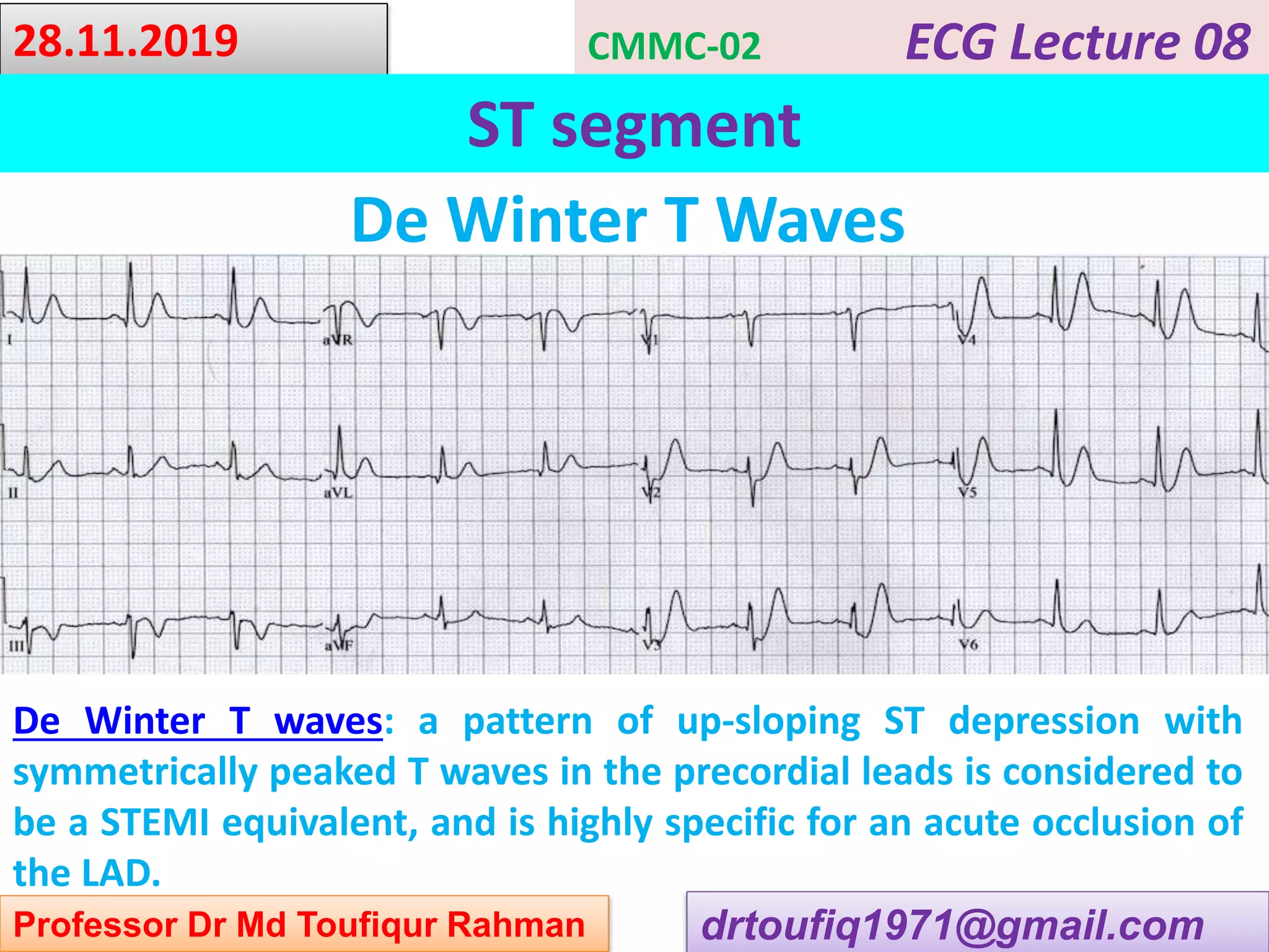 ECG- ST segment | PPSX
