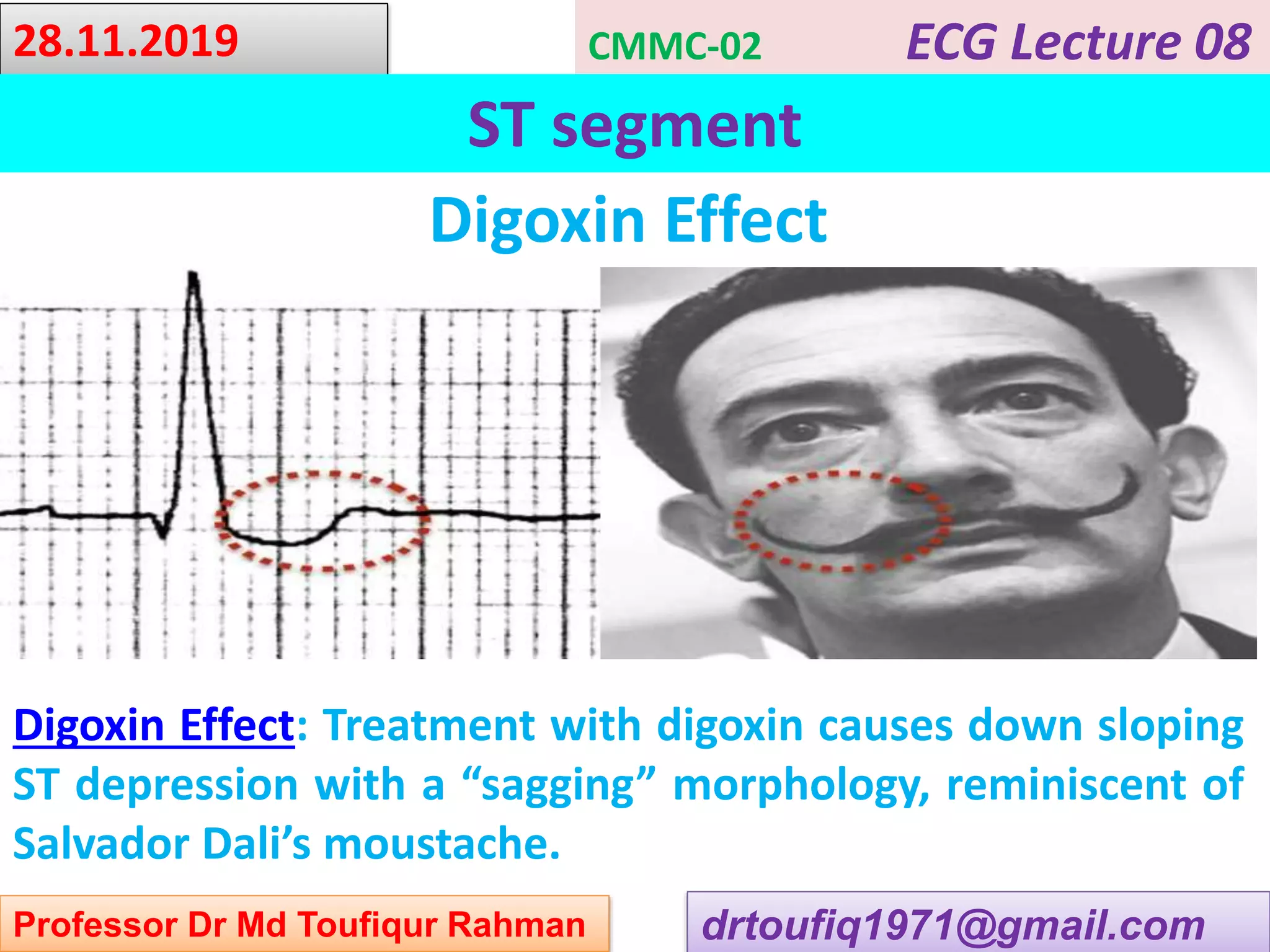 ECG- ST segment | PPSX