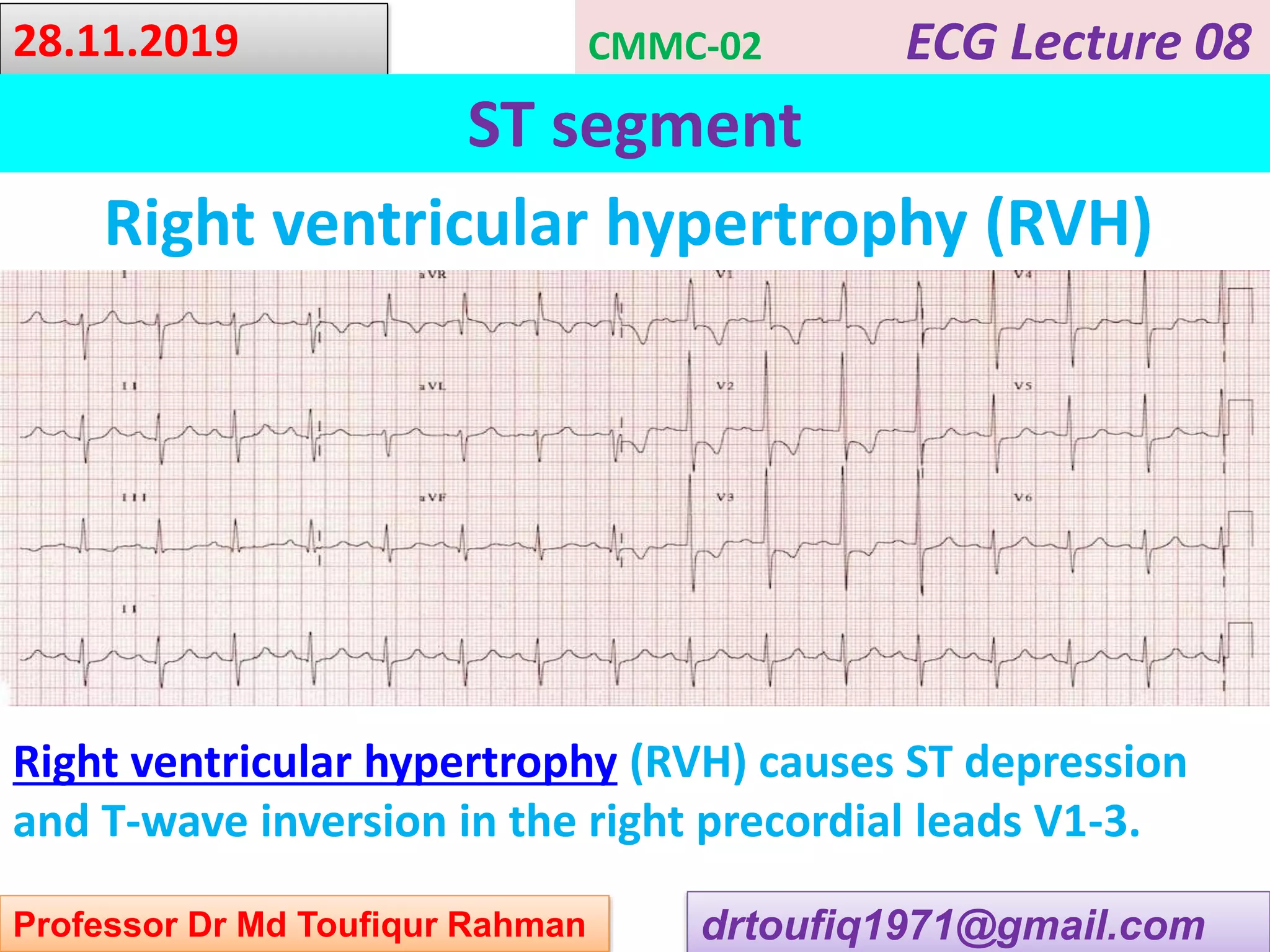 ECG- ST segment | PPSX