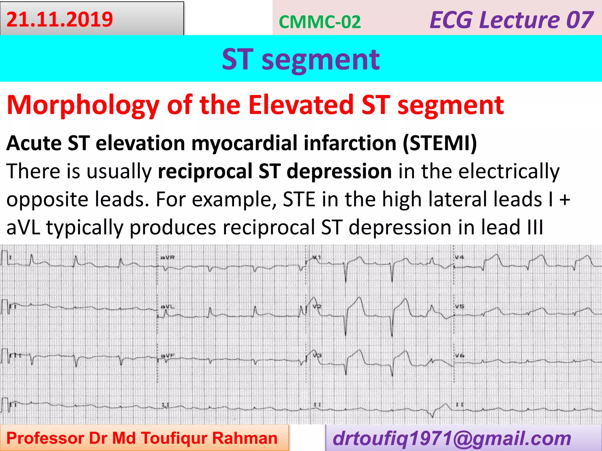 ECG- ST segment | PPSX