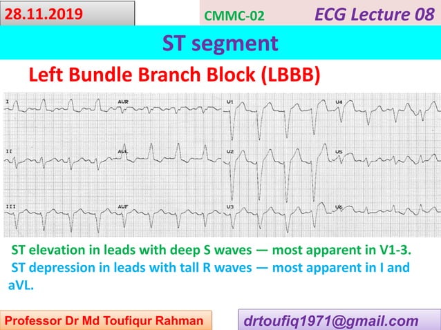 ECG- ST segment | PPSX