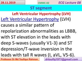 ECG- ST segment | PPSX