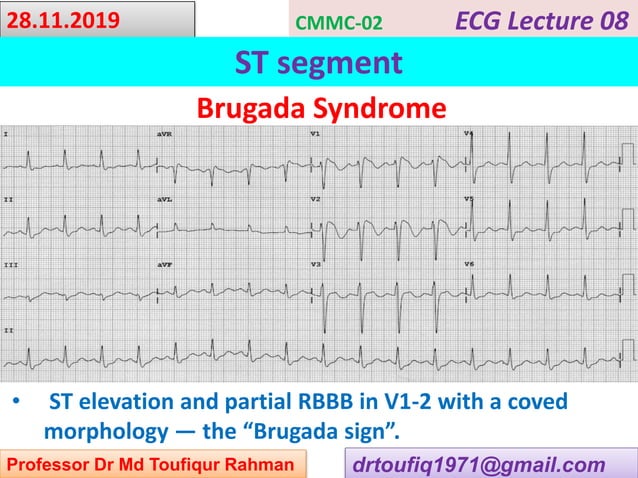 ECG- ST segment | PPSX