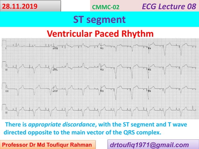 ECG- ST segment | PPSX