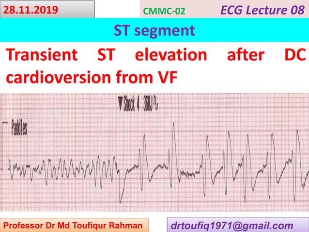 ECG- ST segment | PPSX
