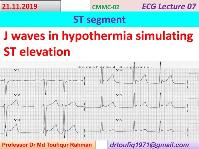 ECG- ST segment | PPSX