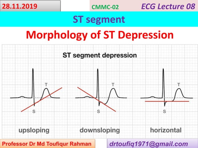 ECG- ST segment | PPSX