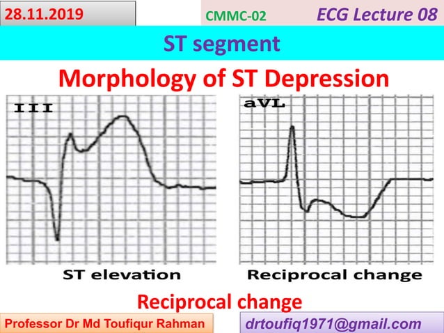 ECG- ST segment | PPSX