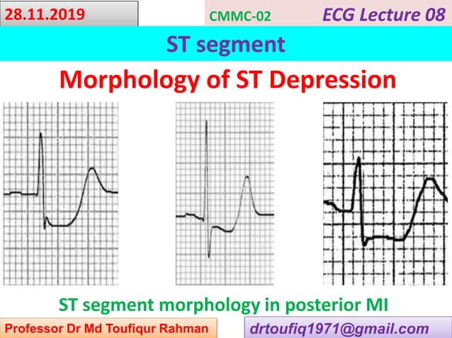 ECG- ST segment | PPSX
