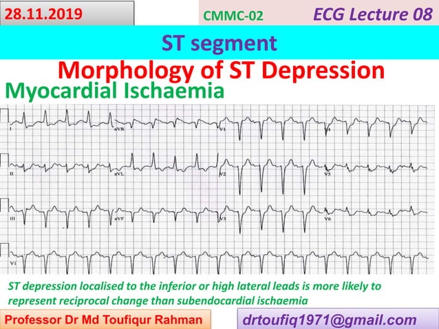 ECG- ST segment | PPSX