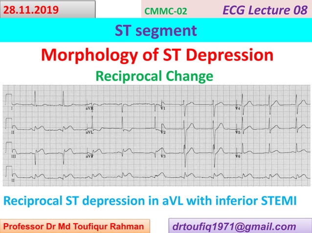 ECG- ST segment | PPSX