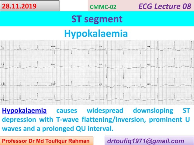 ECG- ST segment | PPSX
