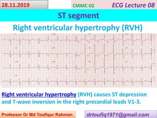 ECG- ST segment | PPSX