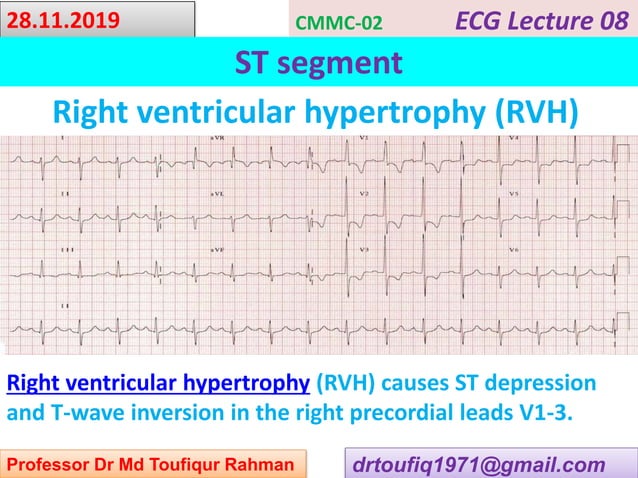 ECG- ST segment | PPSX