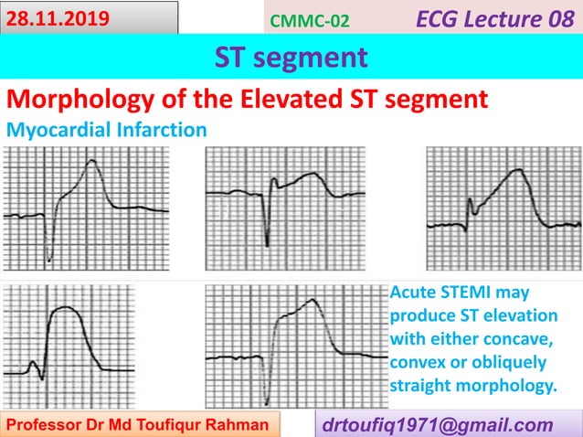 ECG- ST segment | PPSX