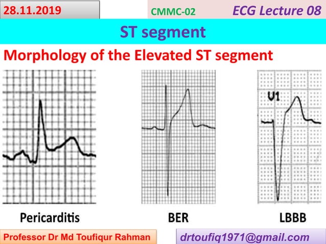 ECG- ST segment | PPSX