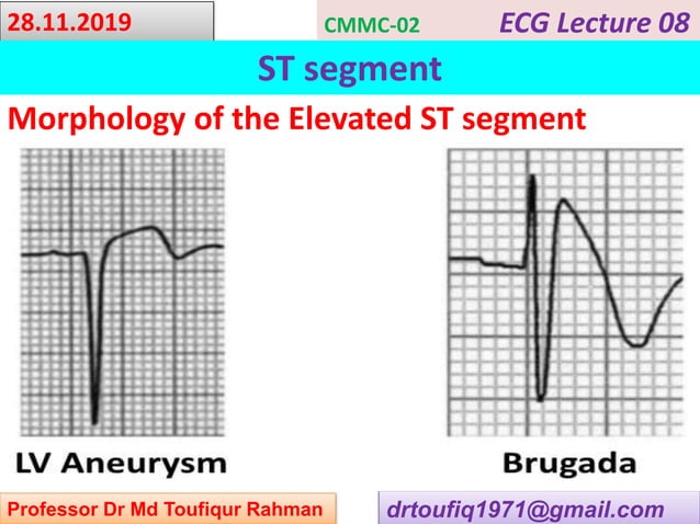 ECG- ST segment | PPSX