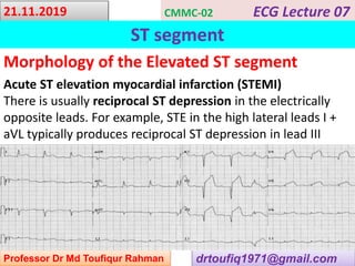 ECG- ST segment | PPSX