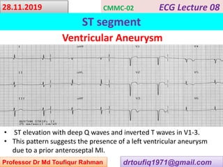 Inferior St Depression Ekg