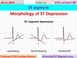 St Segment Depression