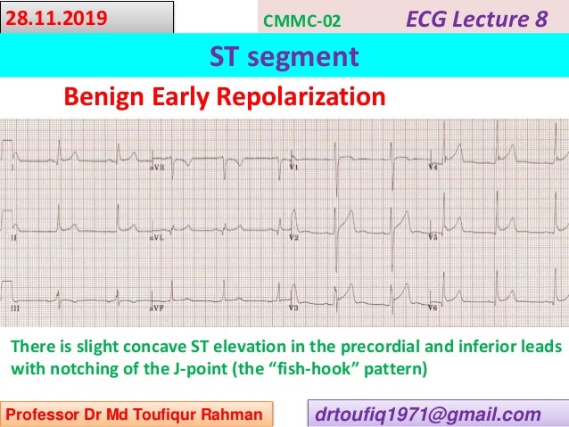 ECG- ST segment