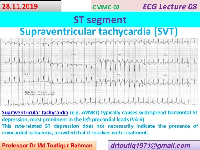 ECG- ST segment