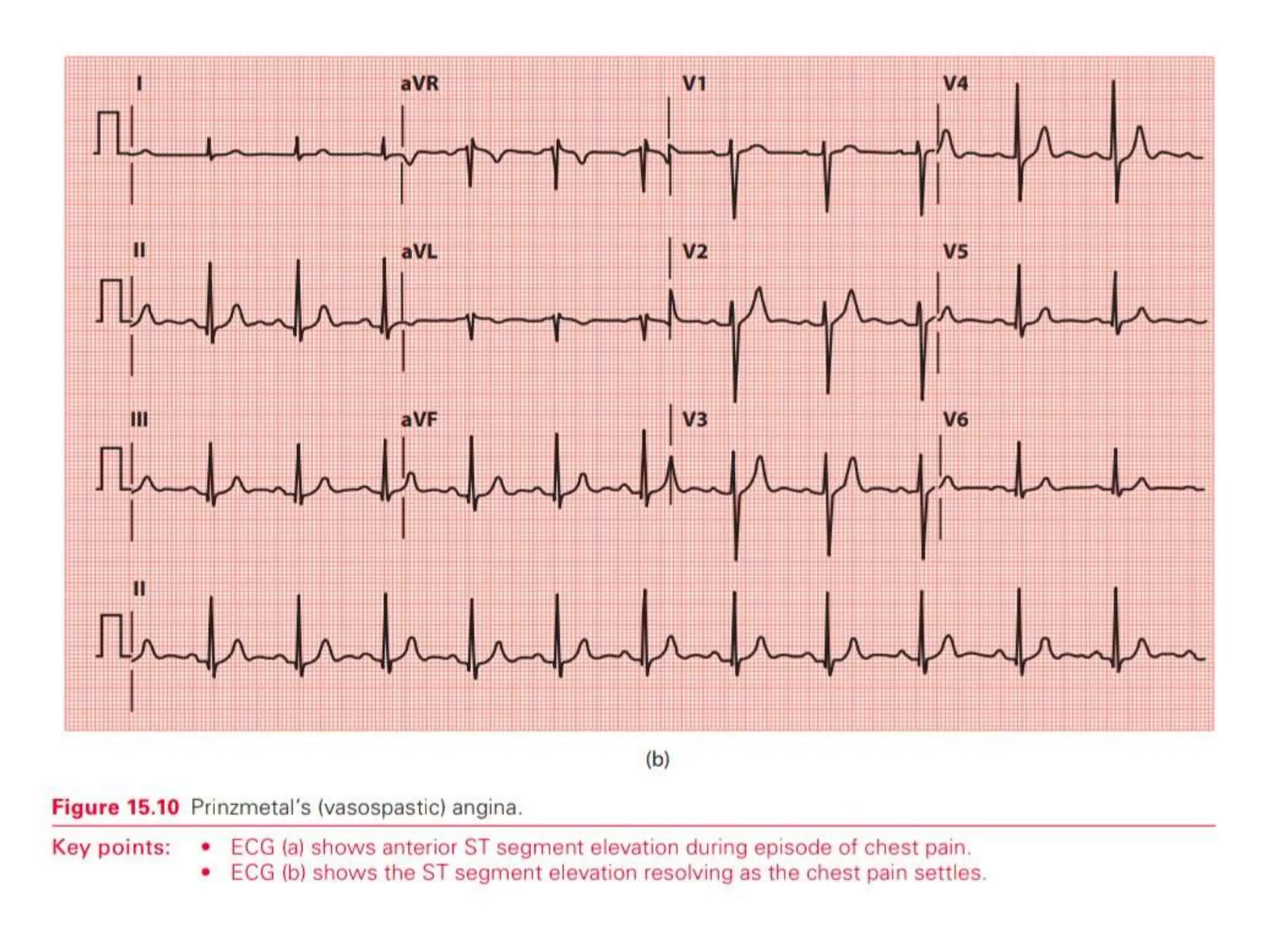 ST SEGMENT IN ECG,ST ELEVATION AND ST DEPRESSION | PPTX