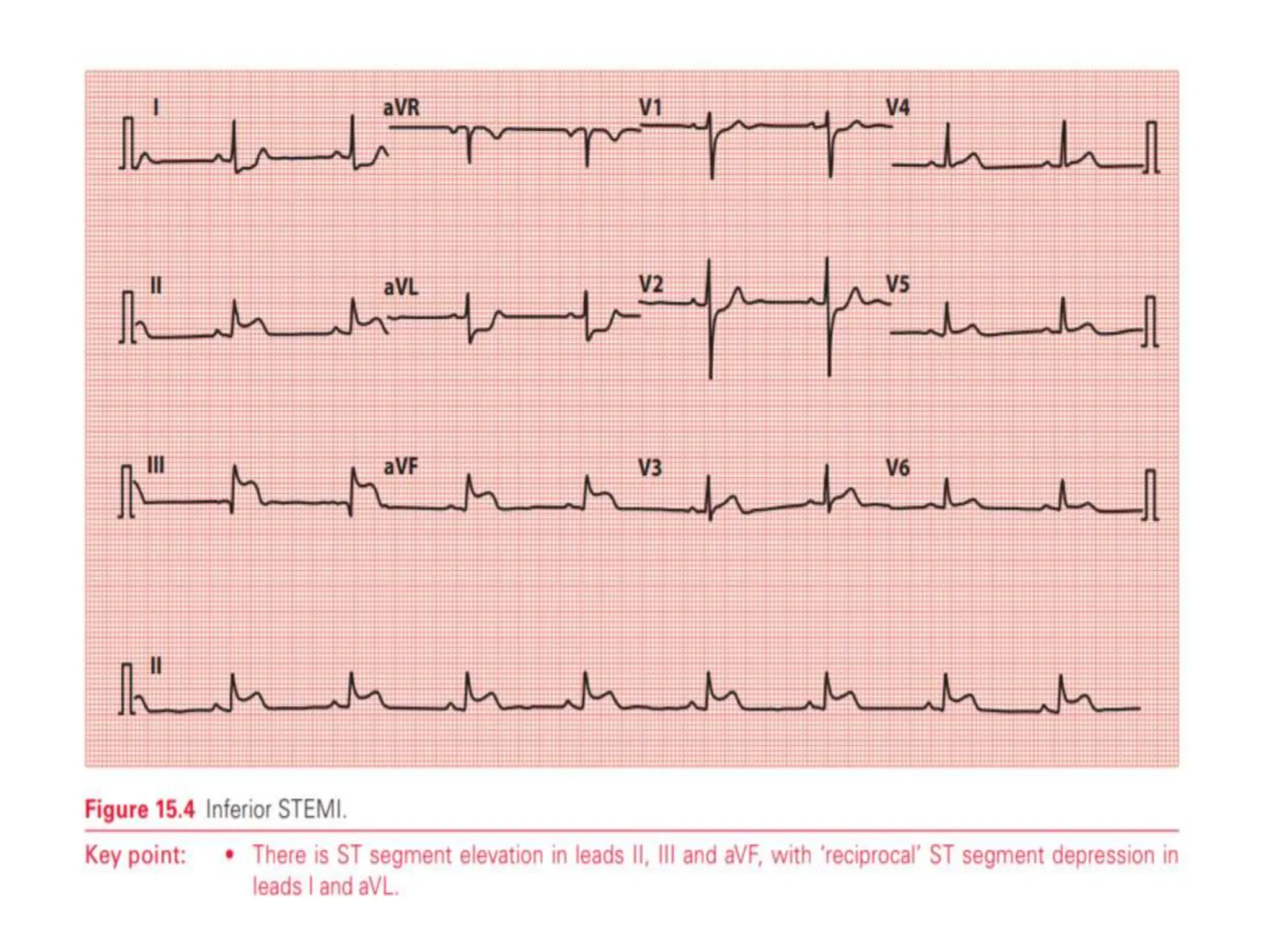 ST SEGMENT IN ECG,ST ELEVATION AND ST DEPRESSION | PPTX