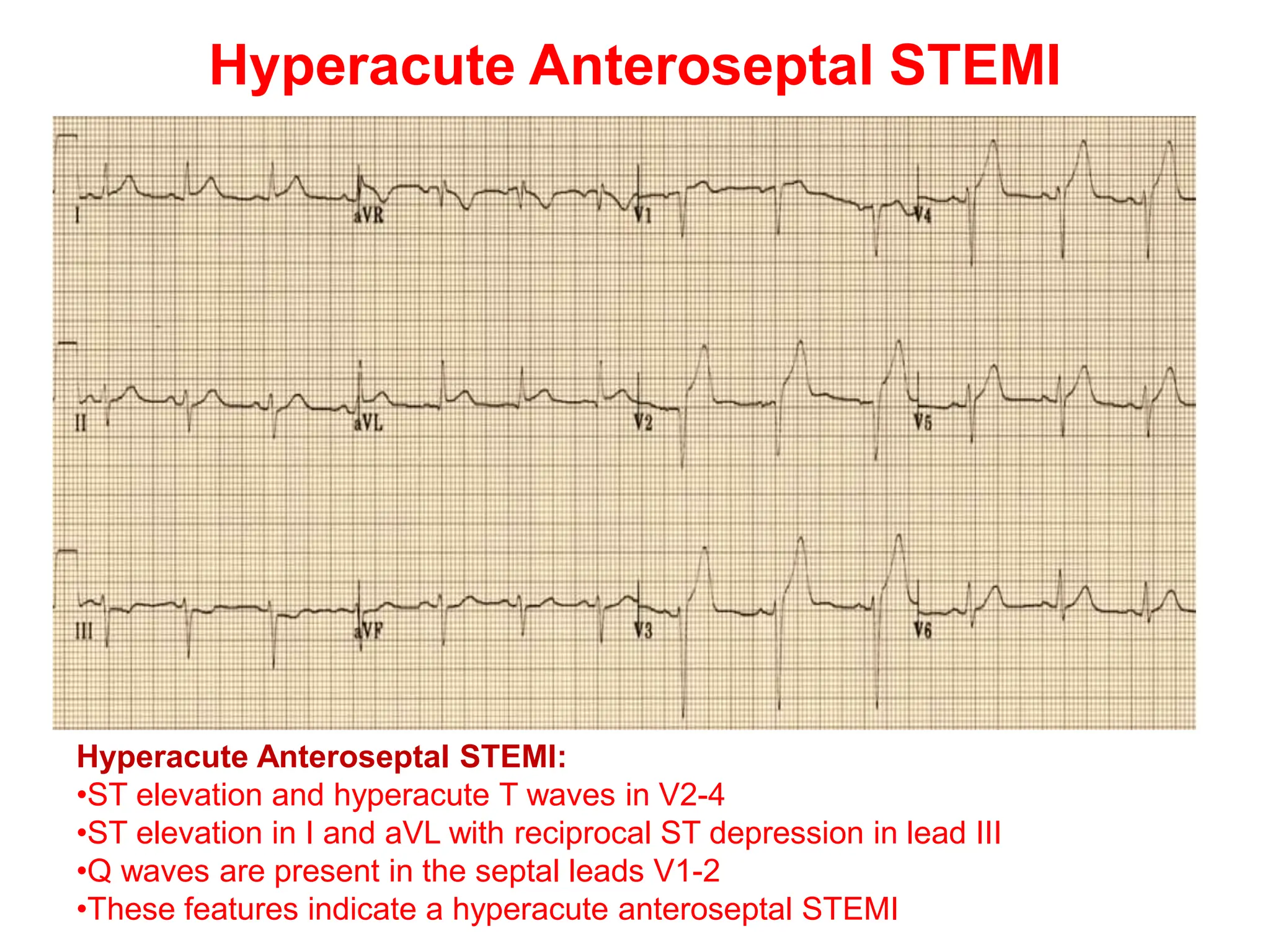 ST SEGMENT IN ECG,ST ELEVATION AND ST DEPRESSION | PPTX