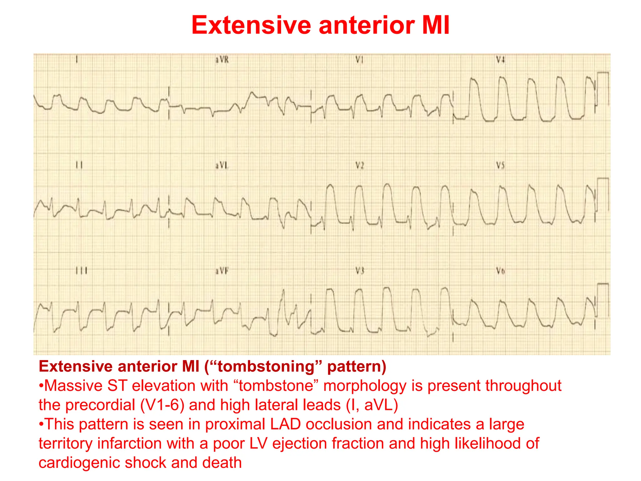 ST SEGMENT IN ECG,ST ELEVATION AND ST DEPRESSION | PPTX
