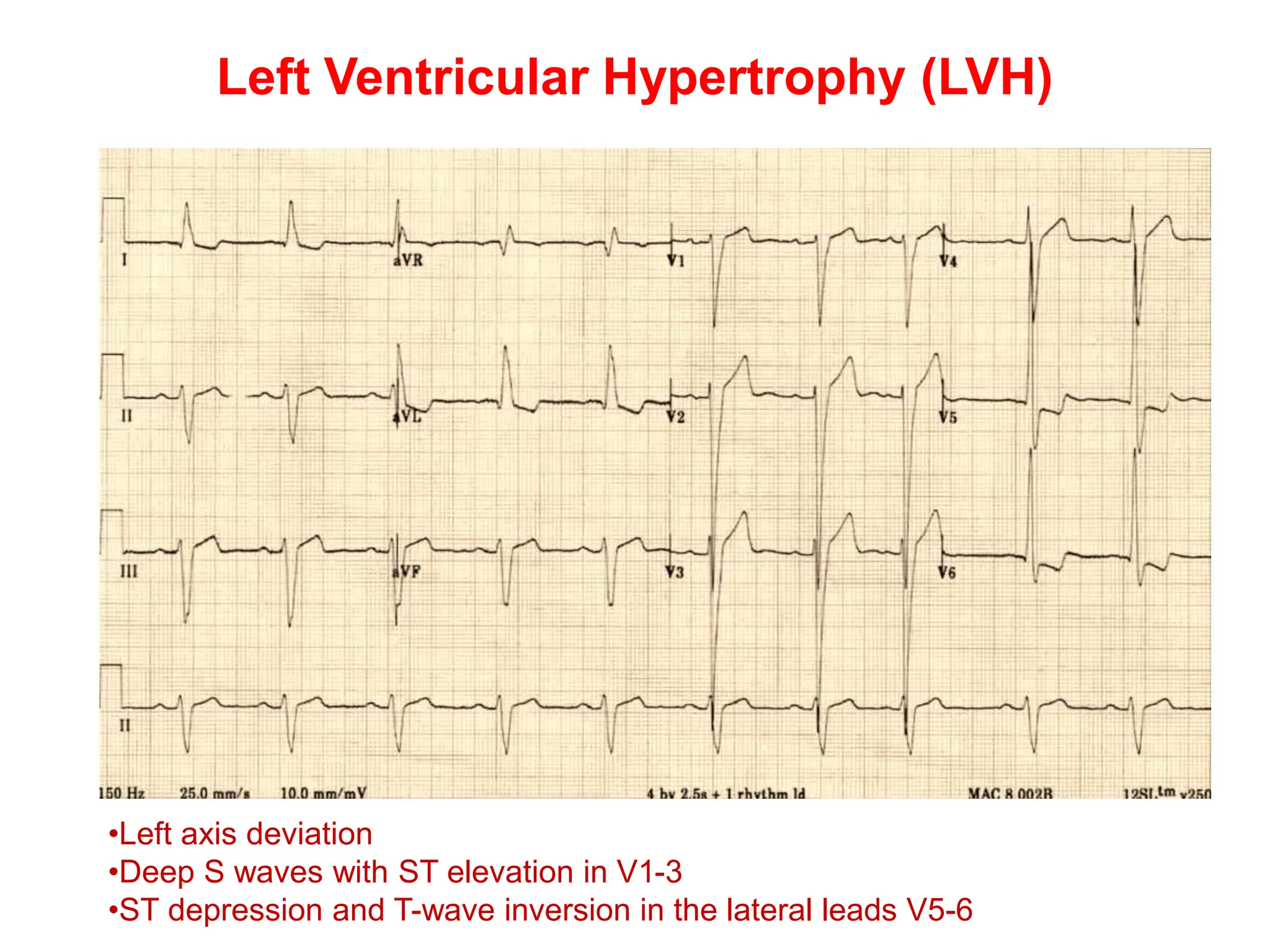 ST SEGMENT IN ECG,ST ELEVATION AND ST DEPRESSION | PPTX