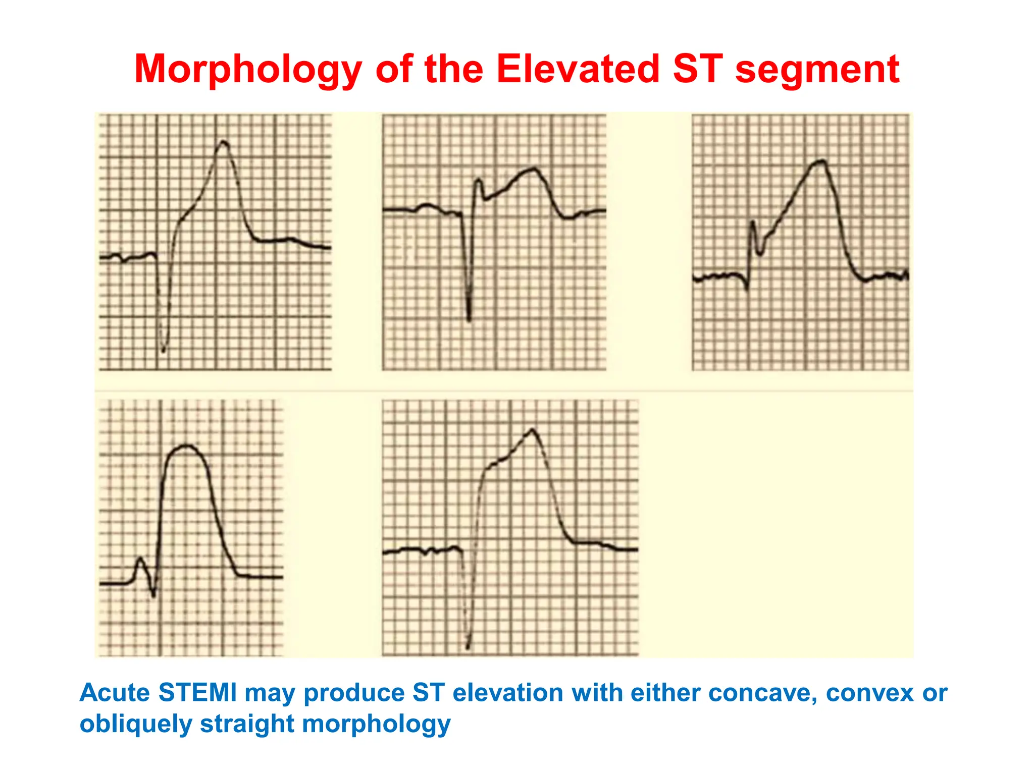 ST SEGMENT IN ECG,ST ELEVATION AND ST DEPRESSION | PPTX