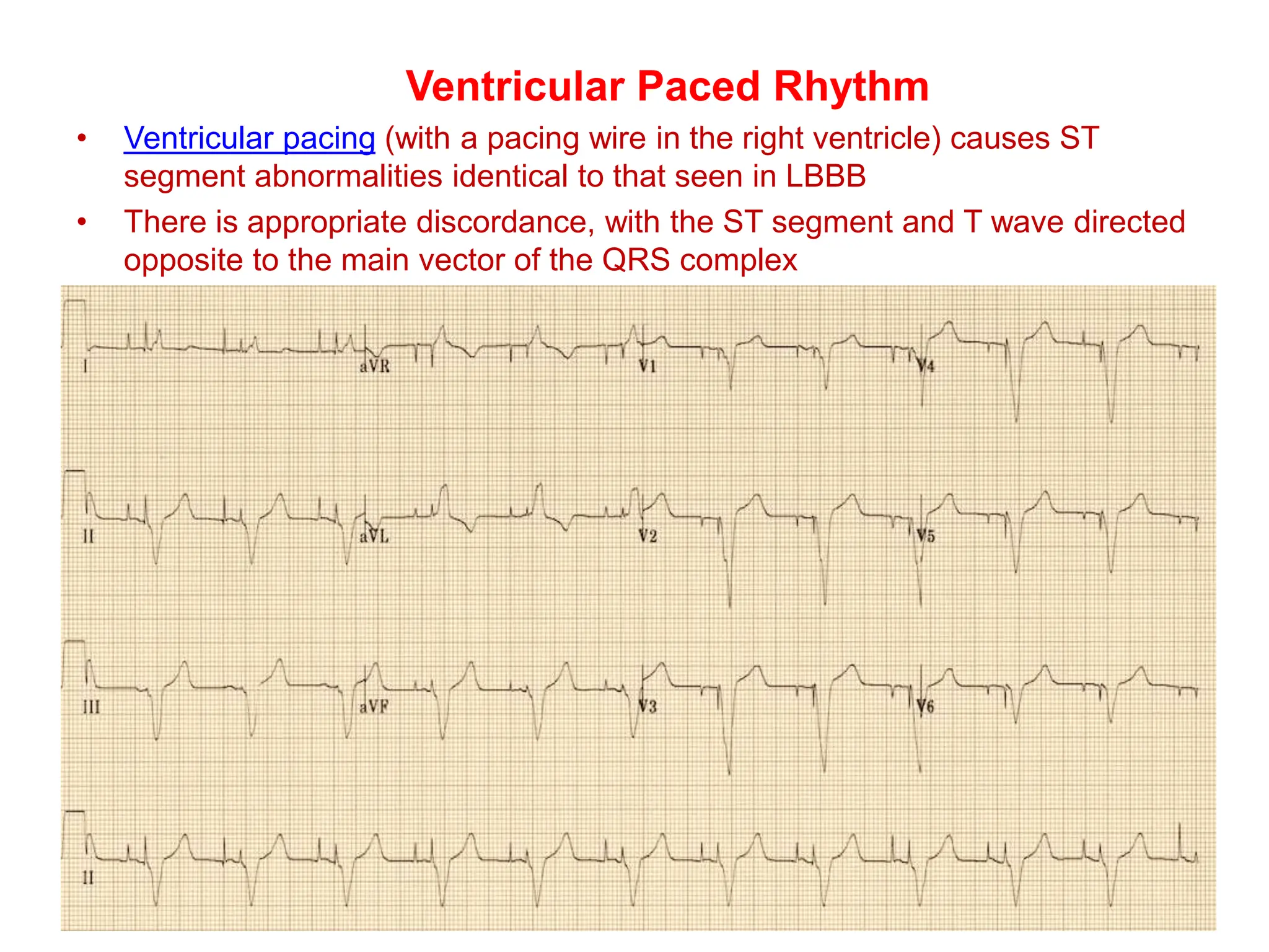 ST SEGMENT IN ECG,ST ELEVATION AND ST DEPRESSION | PPTX