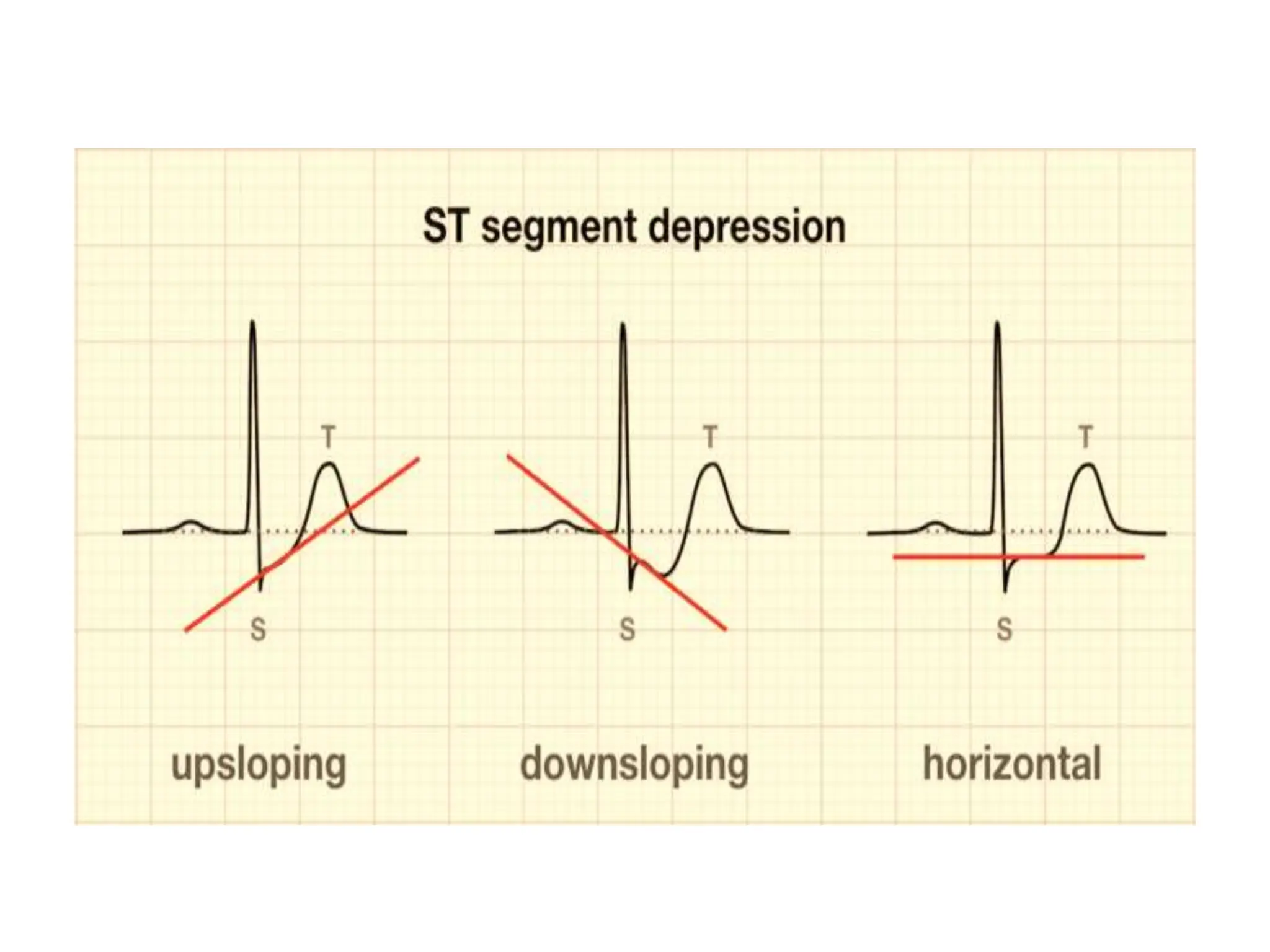 ST SEGMENT IN ECG,ST ELEVATION AND ST DEPRESSION | PPTX