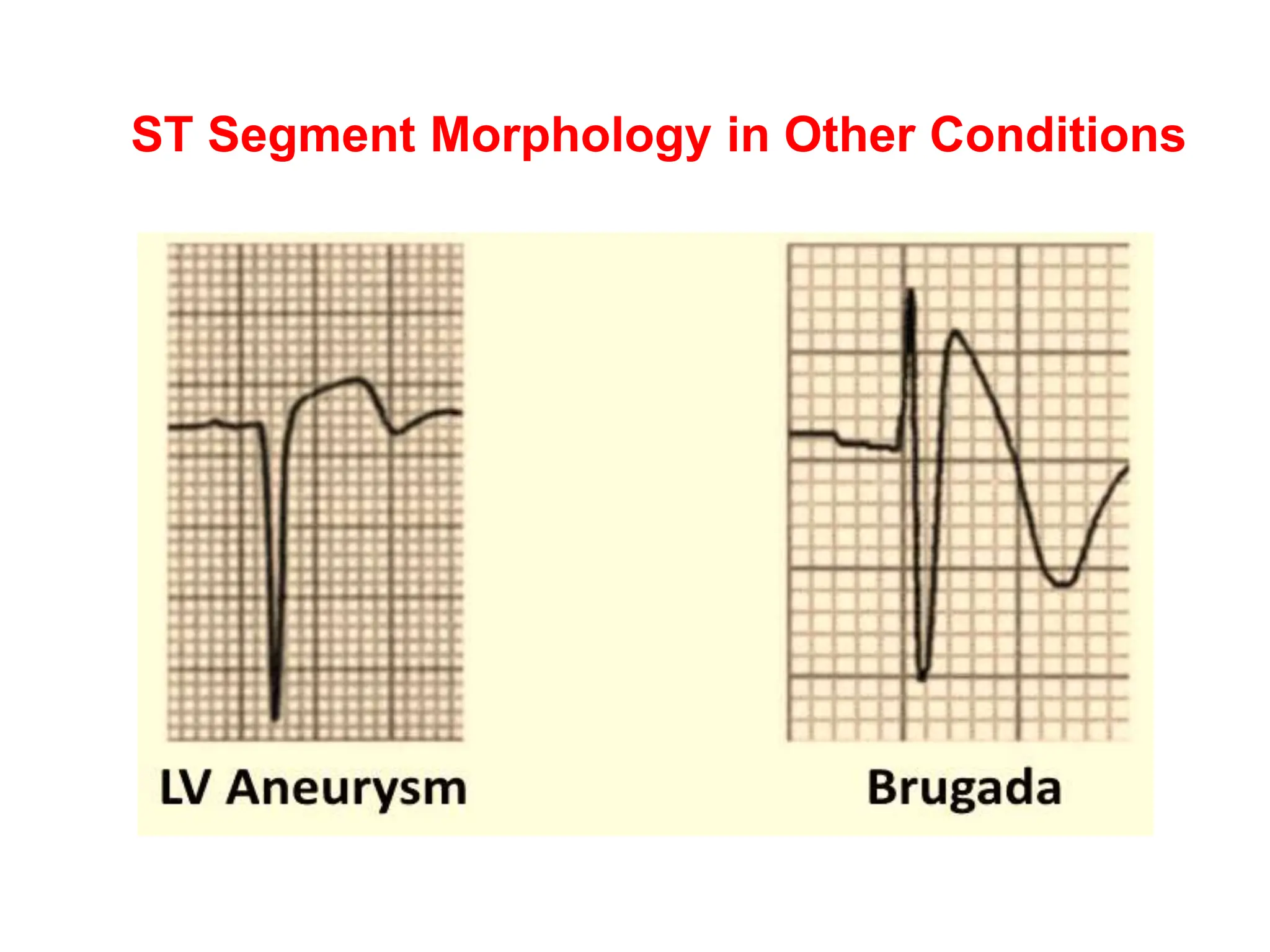 ST SEGMENT IN ECG,ST ELEVATION AND ST DEPRESSION | PPTX