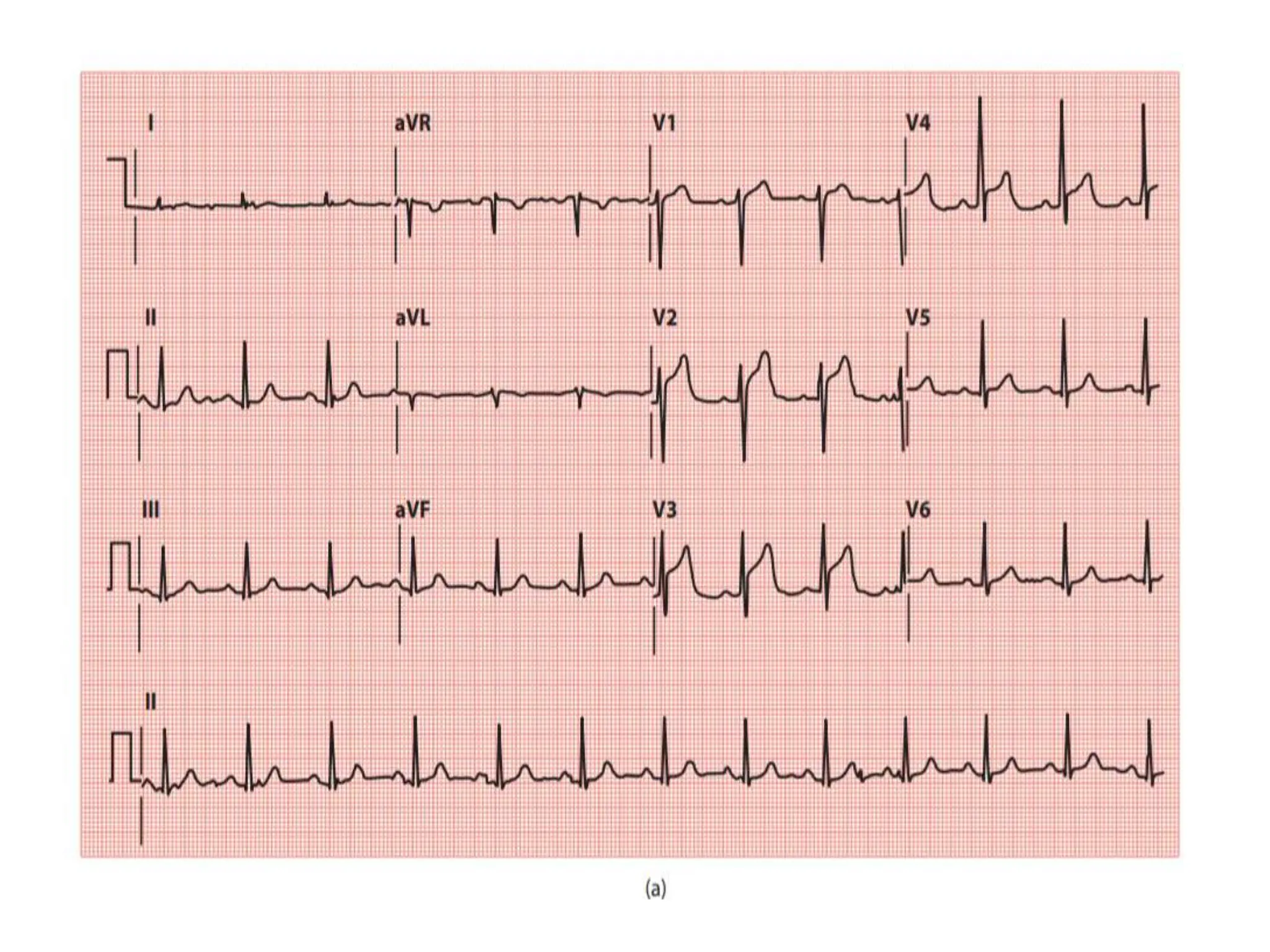 ST SEGMENT IN ECG,ST ELEVATION AND ST DEPRESSION | PPTX