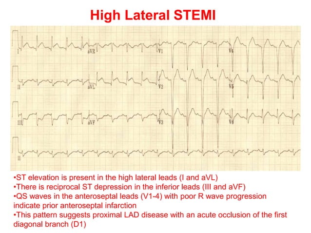 ST SEGMENT IN ECG,ST ELEVATION AND ST DEPRESSION | PPTX