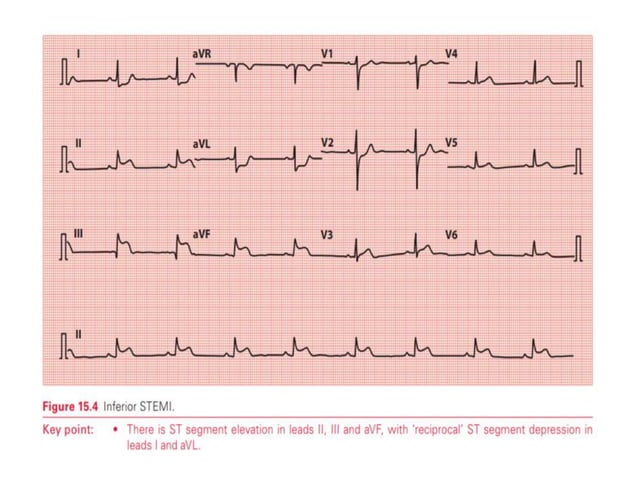 ST SEGMENT IN ECG,ST ELEVATION AND ST DEPRESSION | PPTX